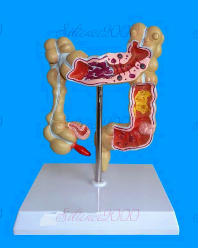 Human Colon Polyp Cancer Ulcer Diseased Organ Anatomical Medical Teach ...