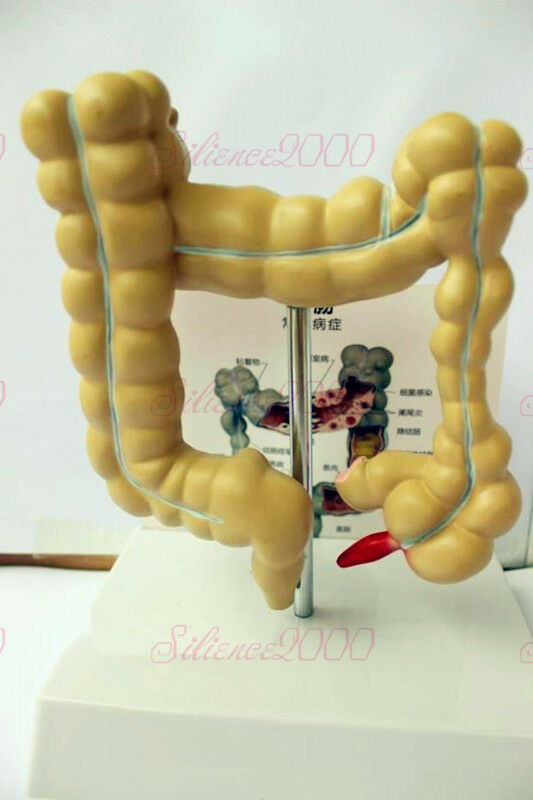 Human Colon Polyp Cancer Ulcer Diseased Organ Anatomical Medical Teach ...